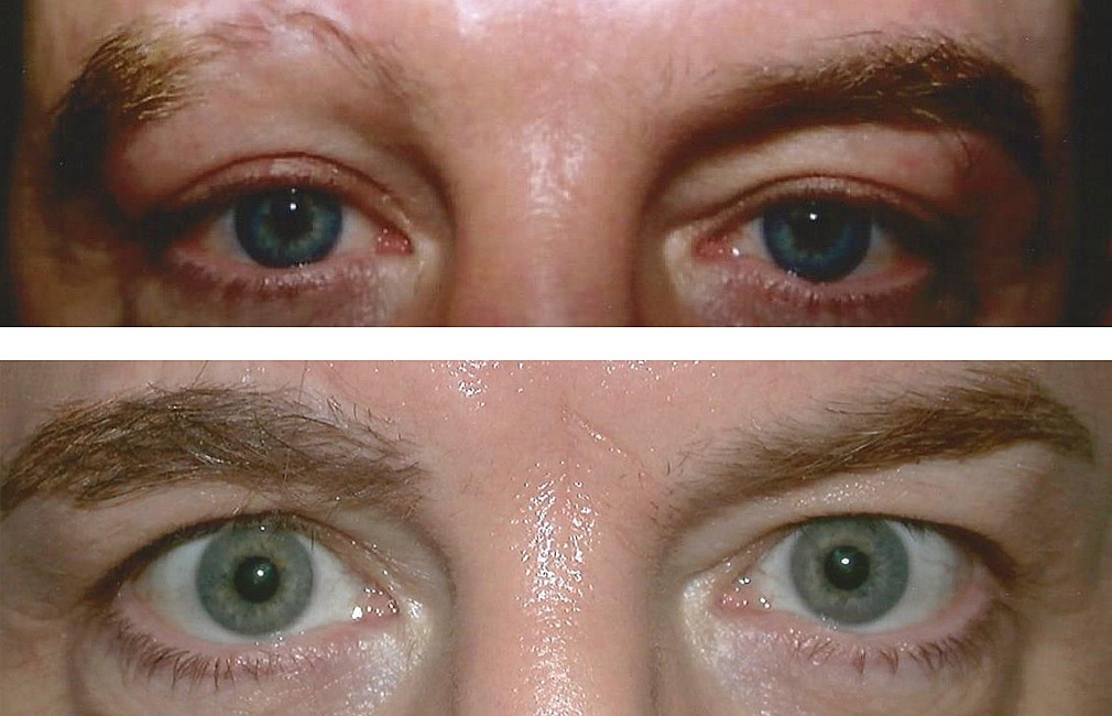 Thinning Eyebrows? Hair Restoration is a Great Remedy | Tucson.com ...